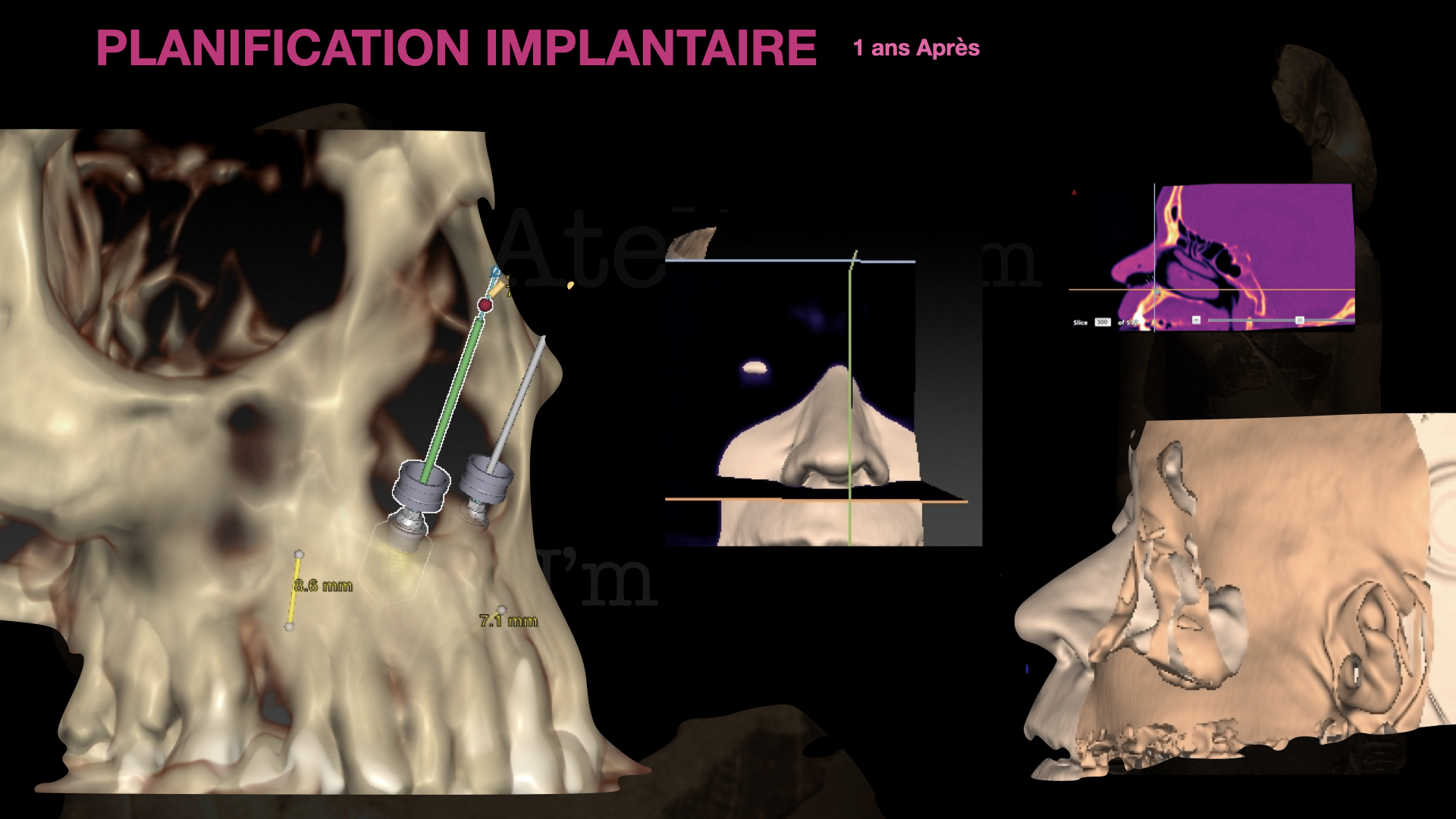 Qu'est ce que l'épithèse ou Prothèse faciale