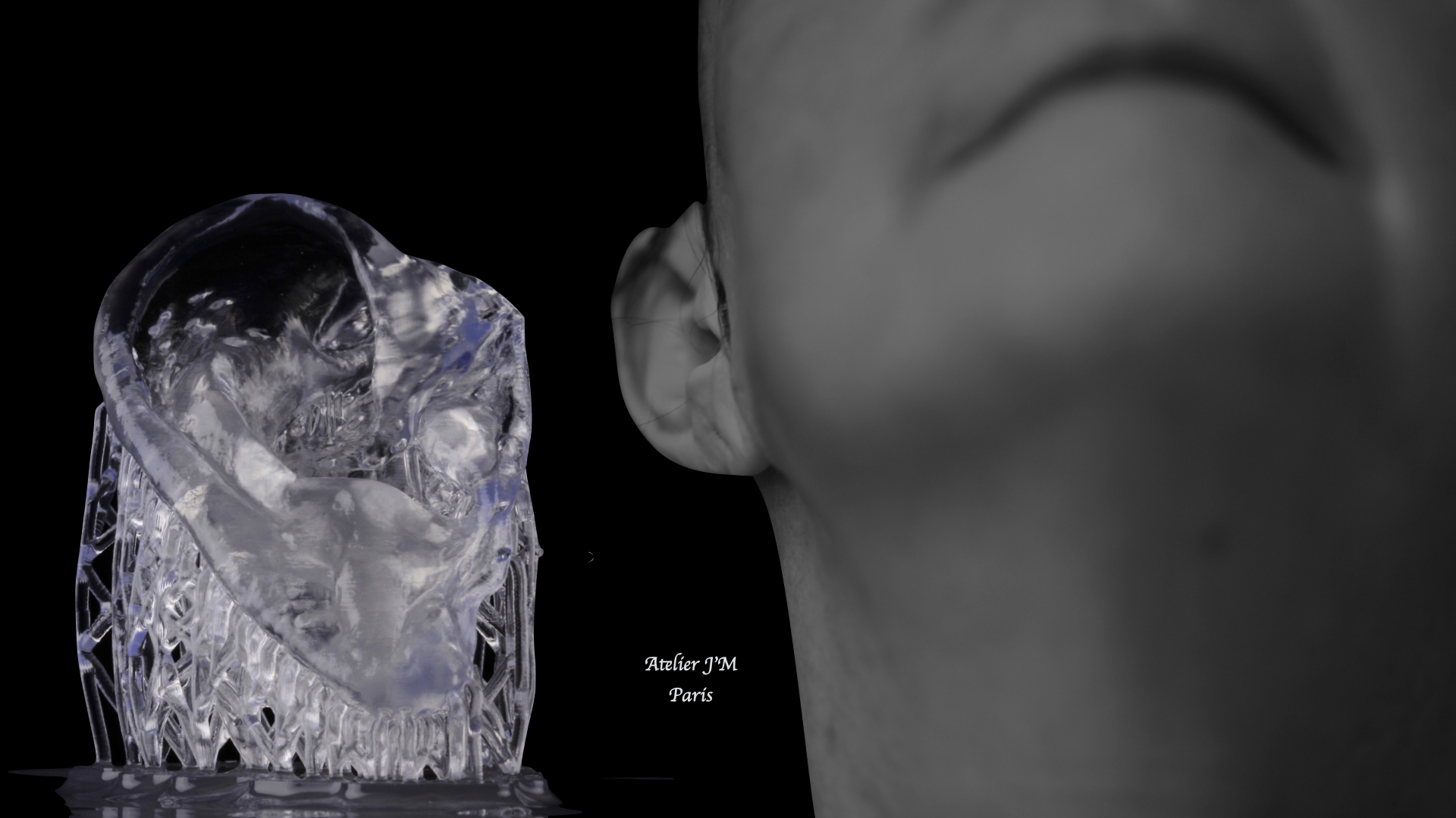 Qu'est ce que l'épithèse ou Prothèse faciale